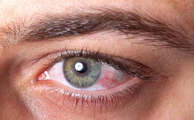 What to Do When Something Gets Stuck in Your Eye