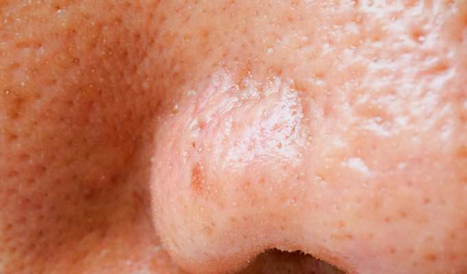 How to Reduce Open Pores Faster? Tips & Treatments!